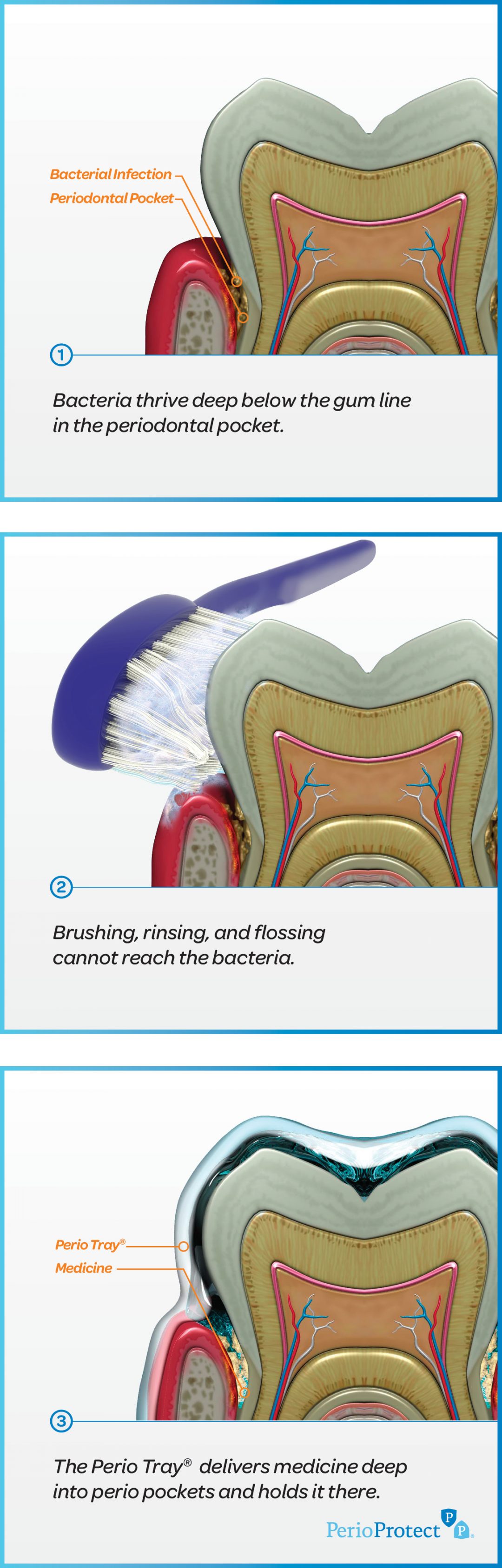 Perio Protect » Dr Florian Braich DDS PhD General and Cosmetic Dentist ...